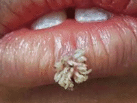 Verrugas filiformes